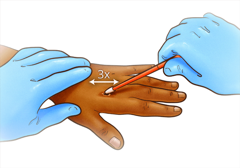 Core Concepts - Mpox - Self-Study Lessons - National STD Curriculum