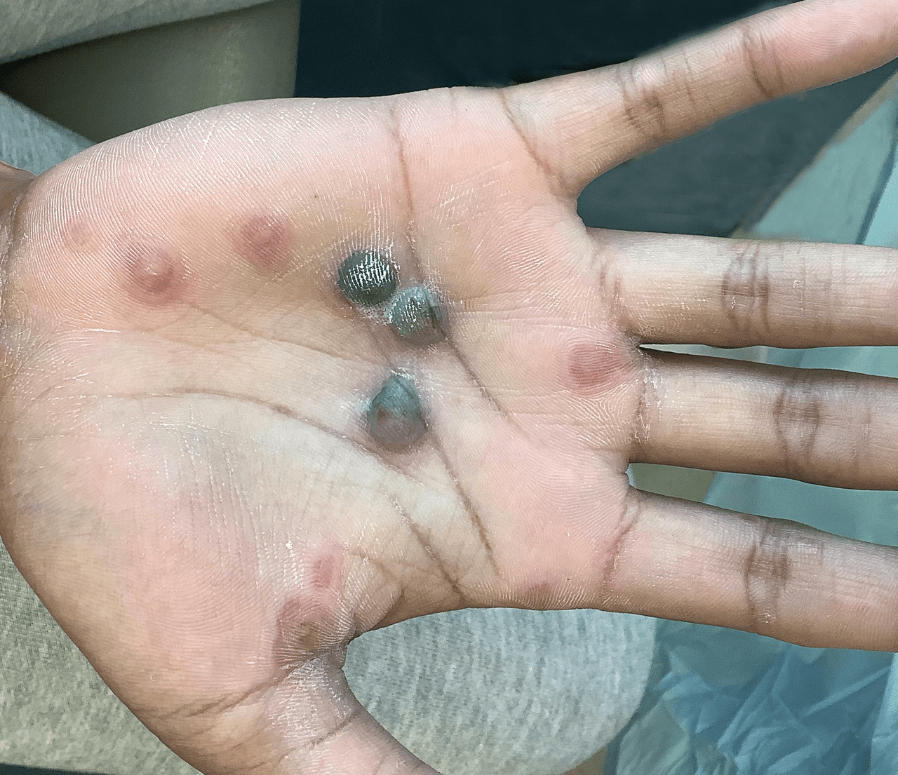 Question 4 - Mpox Question Bank - National STD Curriculum