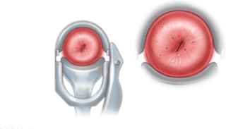 Core Concepts - Vaginitis - Self-Study Lessons - National STD Curriculum