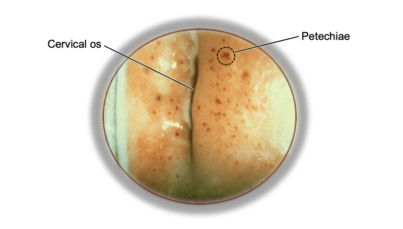 Core Concepts - Vaginitis - Self-Study Lessons - National STD Curriculum