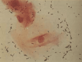 Core Concepts - Vaginitis - Self-Study Lessons - National STD Curriculum