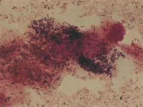 Core Concepts - Vaginitis - Self-Study Lessons - National STD Curriculum