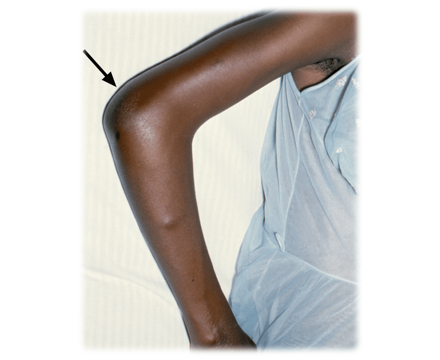 Core Concepts - Gonococcal Infections - Self-Study Lessons - National ...