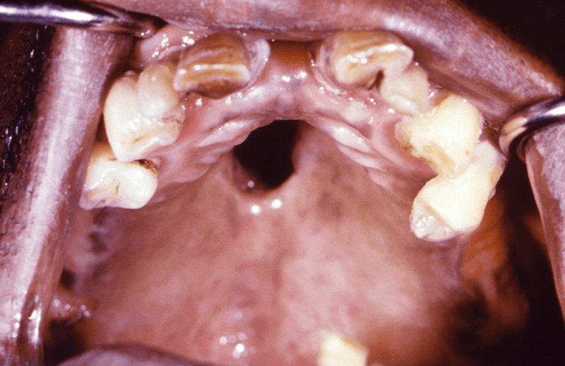 Core Concepts - Syphilis During Pregnancy and Congenital Syphilis ...
