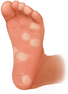Infant - Congenital Syphilis - National STD Curriculum