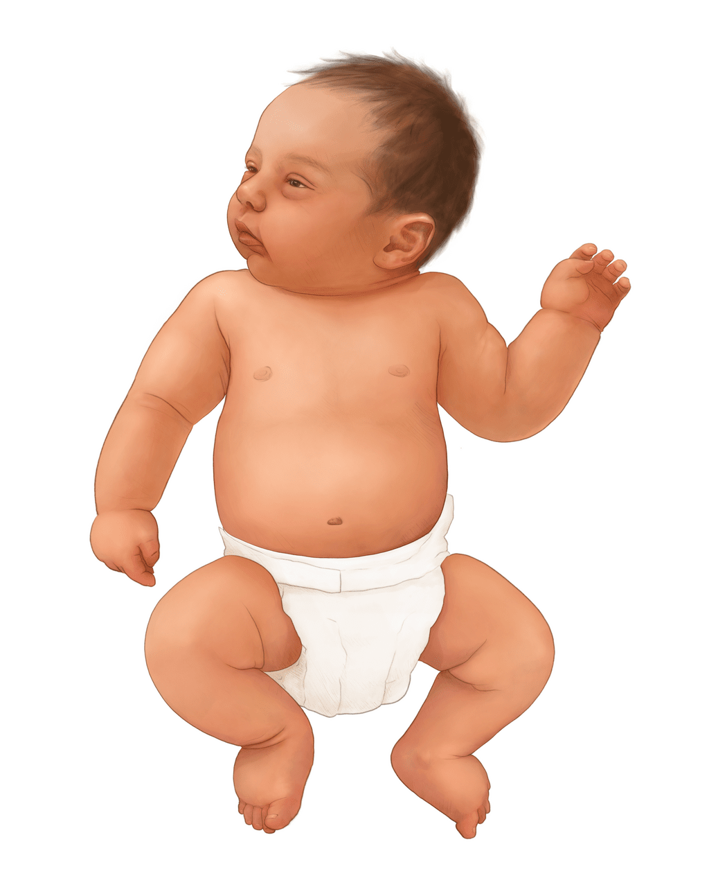Infant - Congenital Syphilis - National STD Curriculum