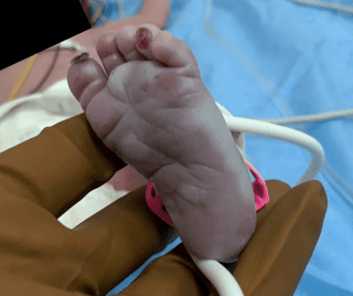 Infant - Congenital Syphilis - National STD Curriculum