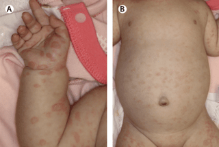 Infant - Congenital Syphilis - National STD Curriculum